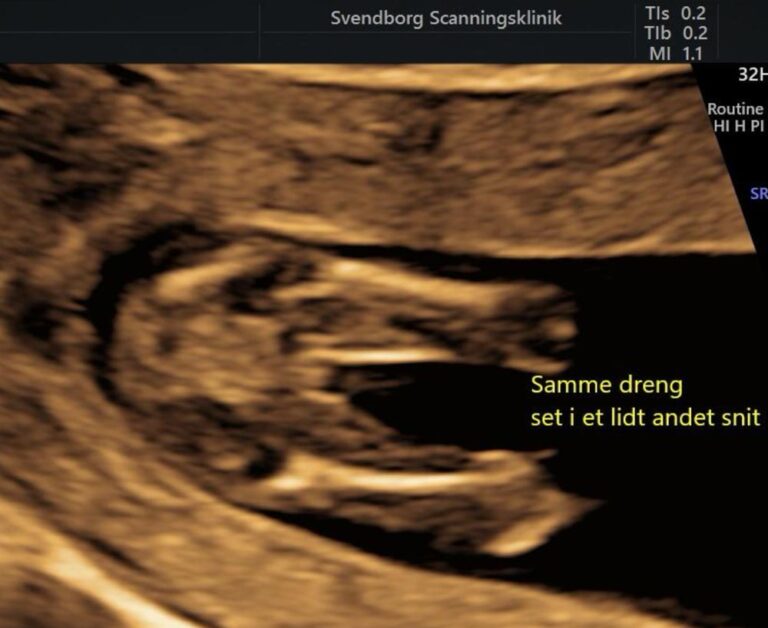 Dreng eller pige? Læs om NUB teori og kønsscanning her