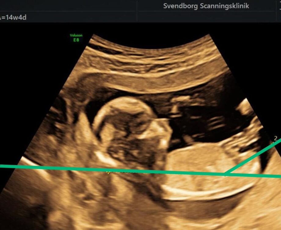 Dreng eller pige? Læs om NUB teori og kønsscanning her